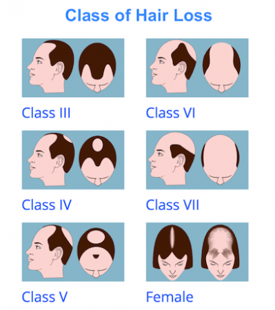 Excessive Hair Loss Treatment - Hair Loss Treatment