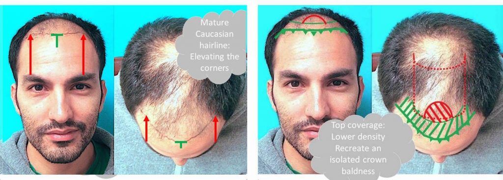 Simplified Hairline Design – A Focus on Shape and Position