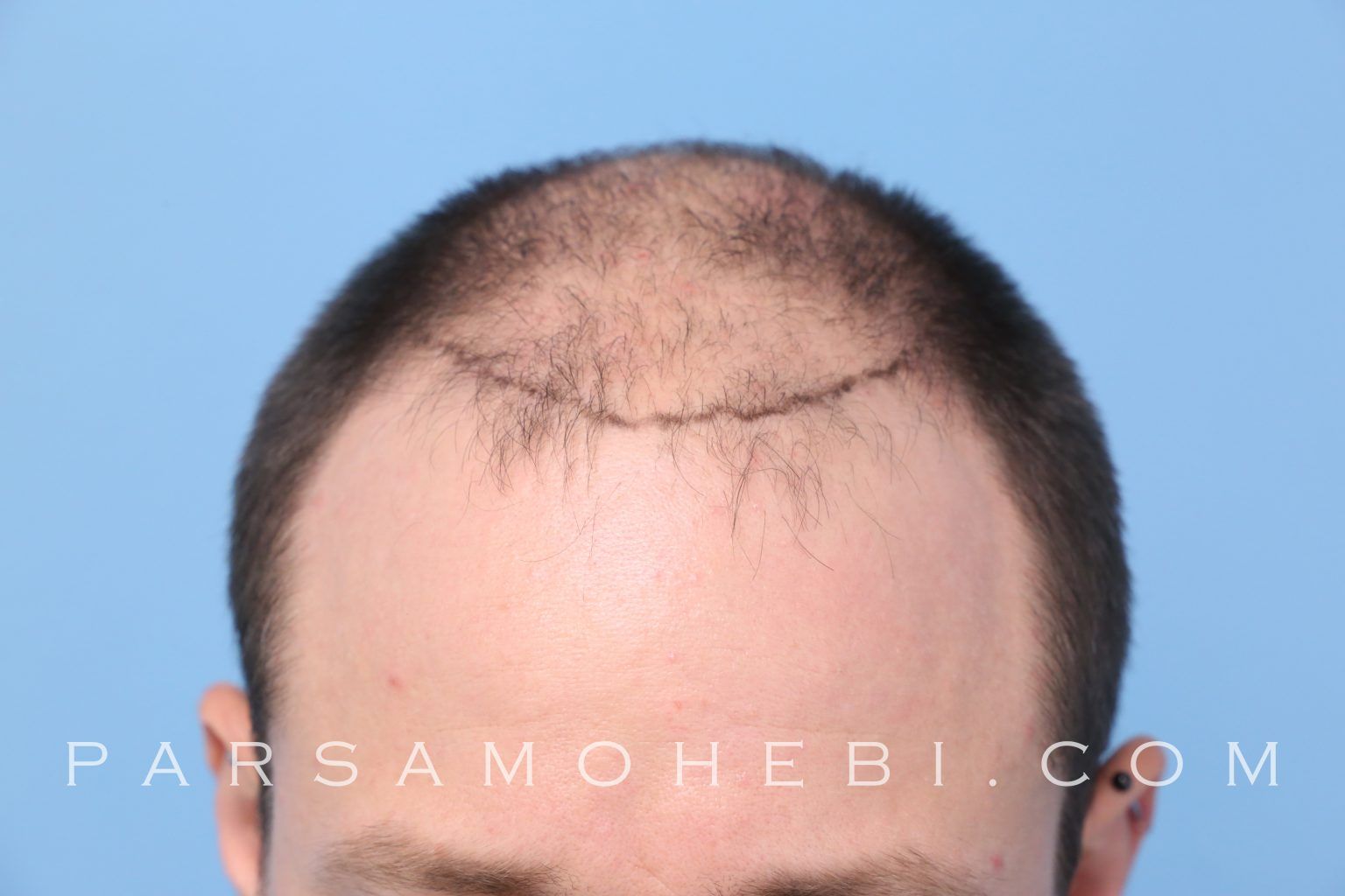 Before And After Fue Hair Transplant 2042 One Procedure 8 Months Elapsed Parsa Mohebi